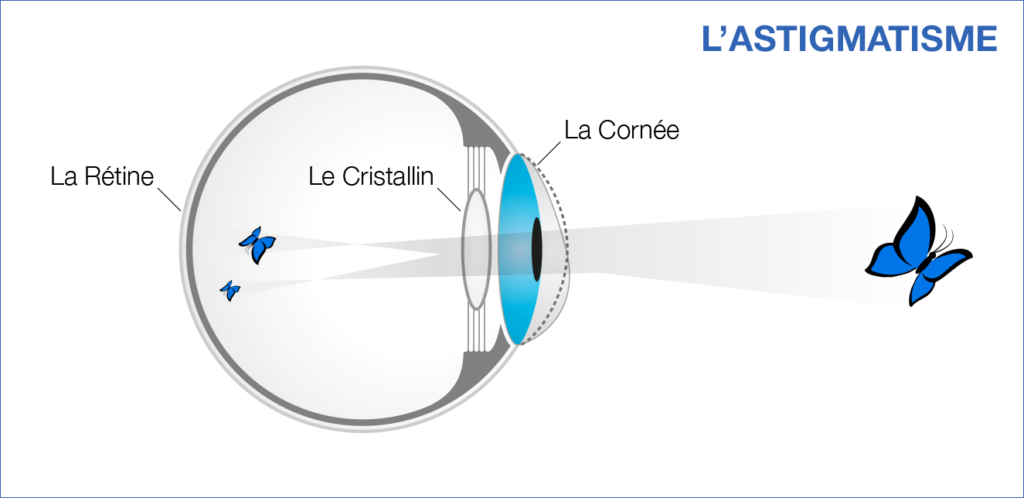 Oeil astigmate - Symptômes, correction et opération de l'astigmatisme