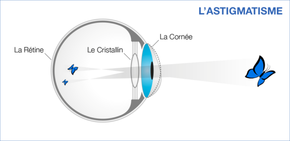 Oeil astigmate - Symptômes, correction et opération de l'astigmatisme