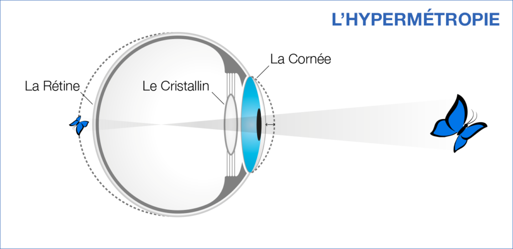 Oeil hypermetrope - Symptômes, causes et opération de l'hypermetropie