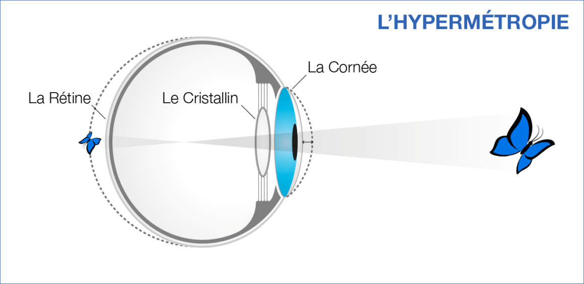 Oeil hypermetrope - Symptômes, causes et opération de l'hypermetropie
