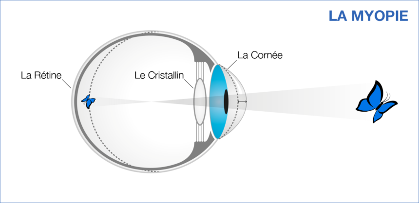 Je suis myope | Symptôme, cause, traitement laser, résultats | New Vision